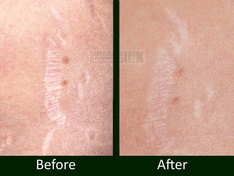 Stretch Marks & Scarring - Shattered Ink Laser Tattoo Removal