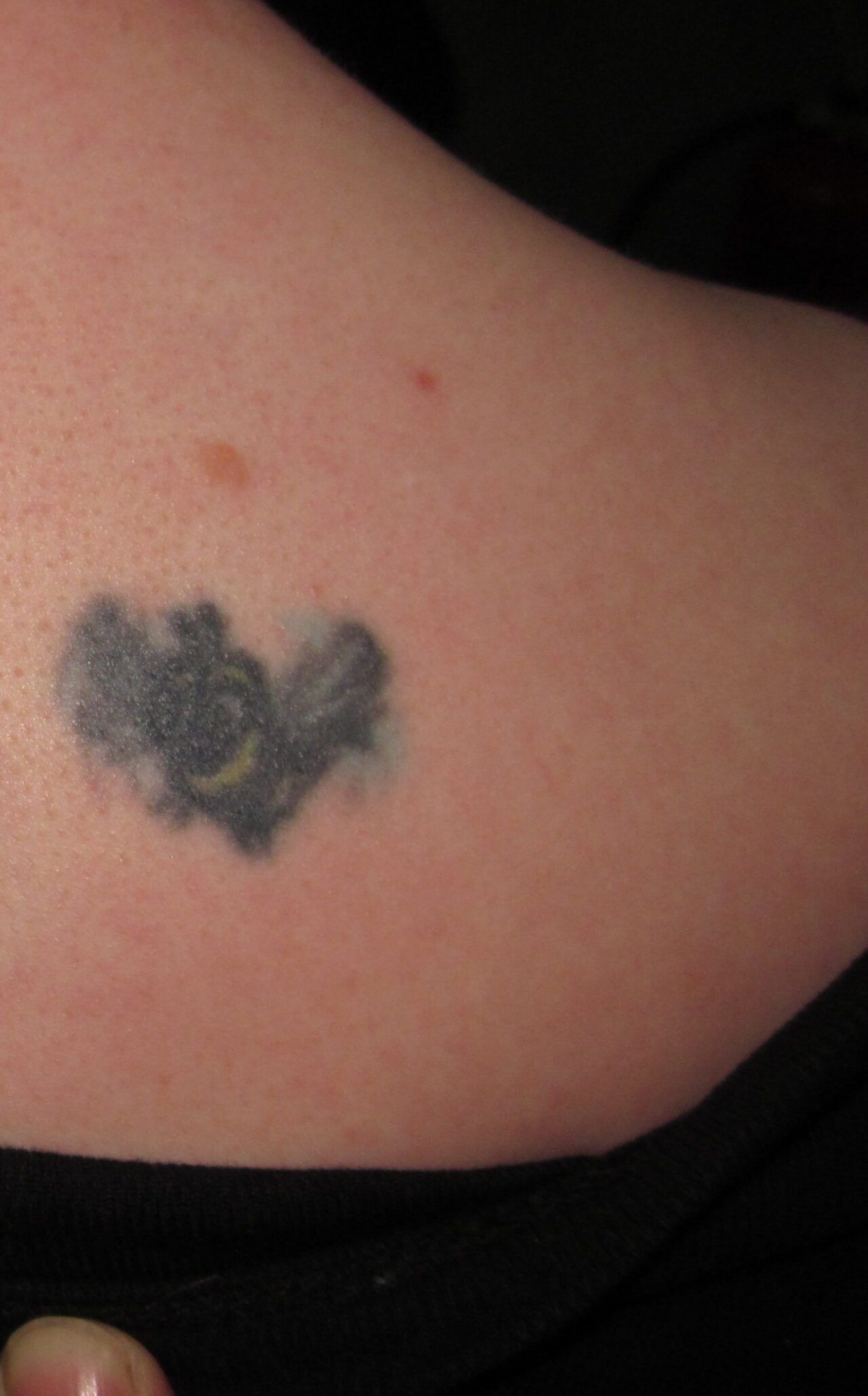 Portfolio - Shattered Ink Laser Tattoo Removal